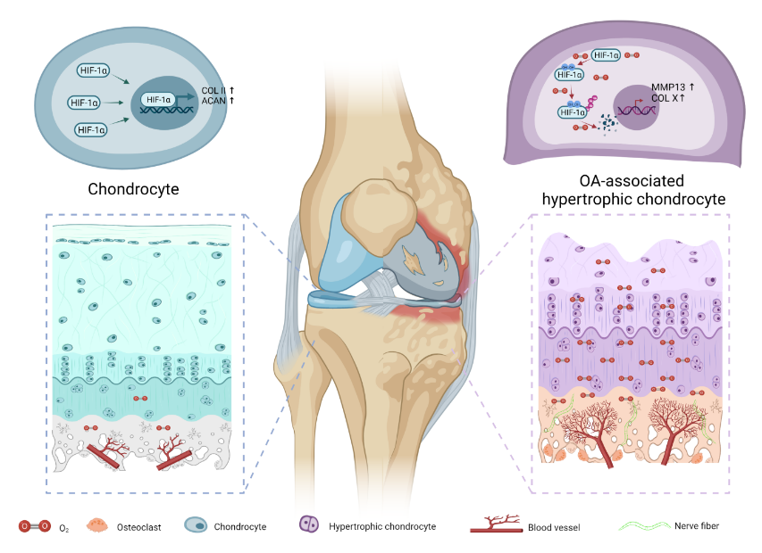 我院苏佳灿教授团队在顶级期刊《Science Advances》上发表了关于OA早期软骨下骨过度激活的破骨细胞促进H型血管生成，引起关节氧微环境改变，是OA发生进展的关键环节的文章-上海大学 ...