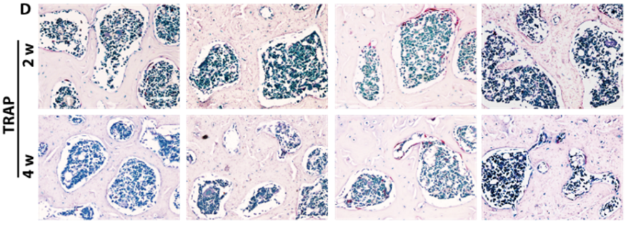 我院苏佳灿教授团队在顶级期刊《Science Advances》上发表了关于OA早期软骨下骨过度激活的破骨细胞促进H型血管生成，引起关节氧微 ...
